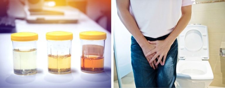 Hormones and Frequent Urination in Men: Is there any Connection?